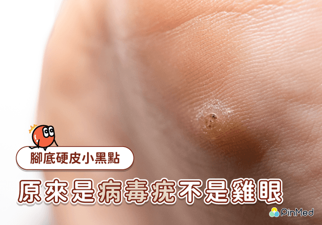 病毒疣原因竟跟子宮頸癌類似！不治療會怎樣，可能自然好嗎？ - PinMed